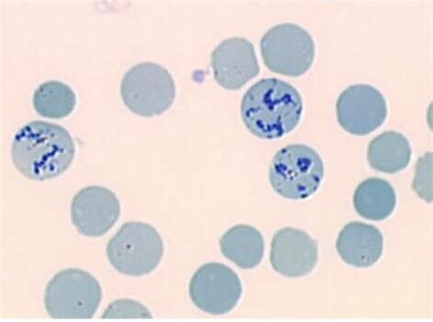 Reticulocyte Wright Stain