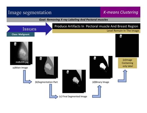 Microcalcification Identification In Digital Mammogram For Early