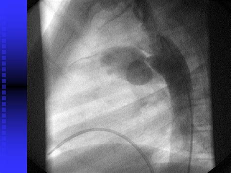 Transcatheter Pda Closure Using The Amplatzer Duct Occluder