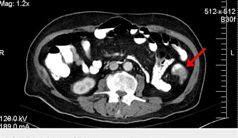 Figure 1 From Enterococcus Faecalis Infective Endocarditis Associated