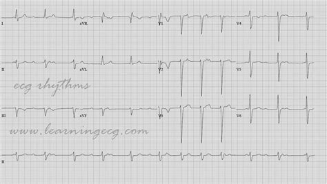 Ecg Rhythms Is This Complete Heart Block