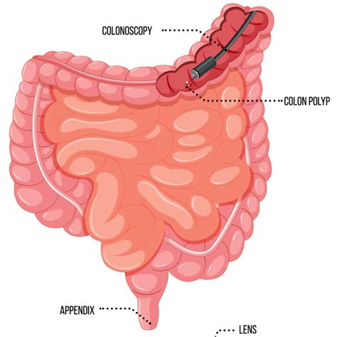 Sigmoidoscopy Gastrosameer