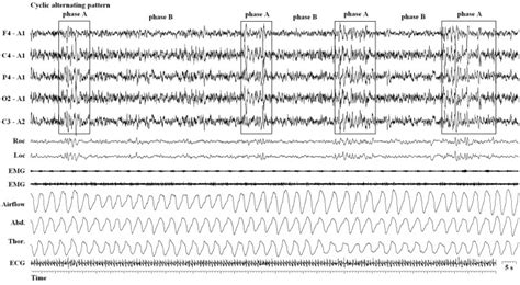 Cyclic Alternating Pattern Scoring In 3 Min Of Non Rapid Eye Movement
