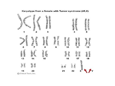 Chromosome Karyotype And Numerical Chromosomal Abnormalities Dr