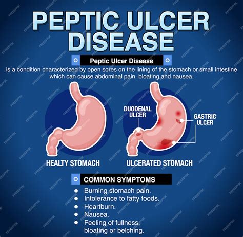 Premium Vector Peptic Ulcer Disease Explained Infographic