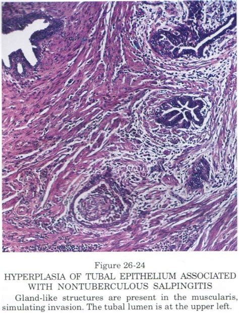 Pathology Outlines Chronic Salpingitis