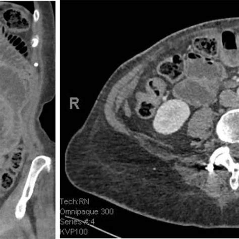 Pdf Retrograde Intussusception Post Roux En Y Gastric Bypass