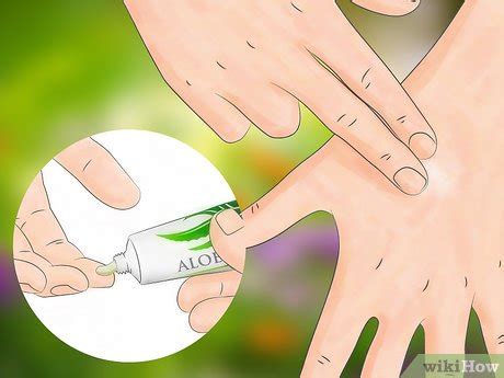 How To Get Bug Bites To Stop Itching With Pictures WikiHow