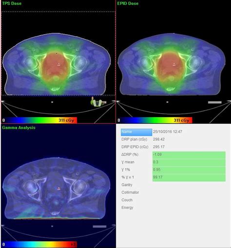 Typical Results Of The Back Projection Method Planned Dose Download Scientific Diagram