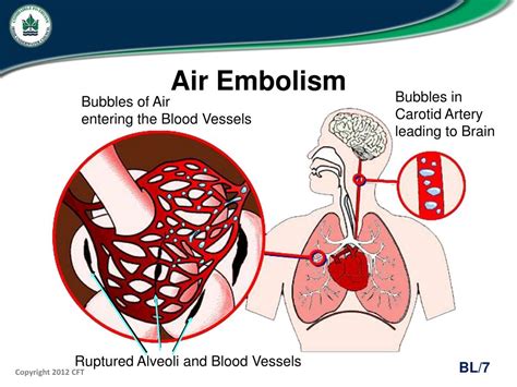 Ppt Burst Lung Powerpoint Presentation Free Download Id 3198349