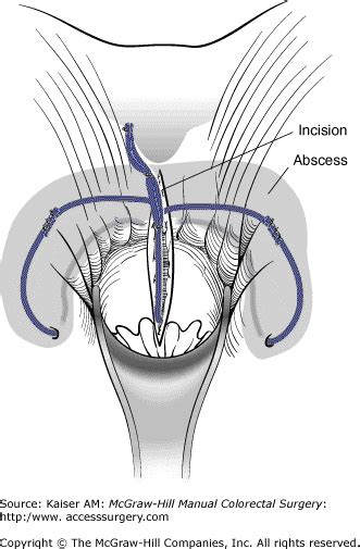 Horseshoe Abscess
