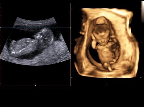 Жирэмсний 11 13 долоо Ирээдүй эмнэлэг Ireedui Emneleg