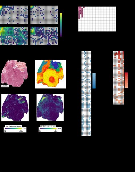 Immune Cell Infiltration And Lipid Heterogeneity In Atrt Brain Tumour