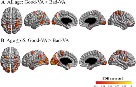 Statistical Topography Of The Relationship Between Cortical Thickness Download Scientific