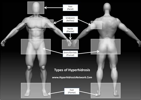 Types Of Hyperhidrosis Hyperhidrosis Network