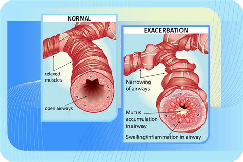American Thoracic Society Exacerbation Of Copd