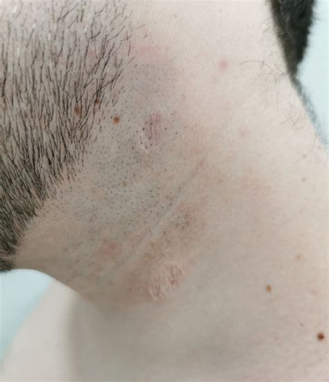 Clinical Manifestations Of Jadassohn Anetoderma In Patient E 34 Years Clinical Manifestations Of Jadassohn Anetoderma In Patient E 34 Years