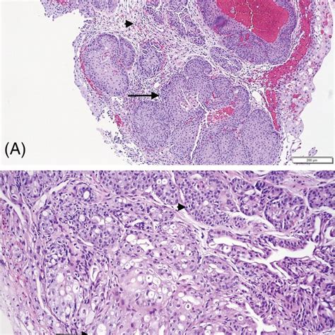 Histopathology Of The Second Biopsy A Polypoid Mucosal Hyperplasia