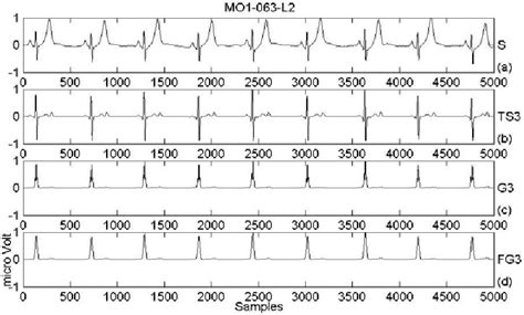 Figure 4 From Detection Of Qrs Complexes In 12 Lead Ecg Using Adaptive Quantized Threshold