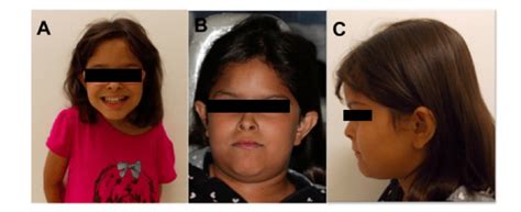 Características Faciais De Paciente Com Síndrome De Deleção 2q373 Como Download Scientific