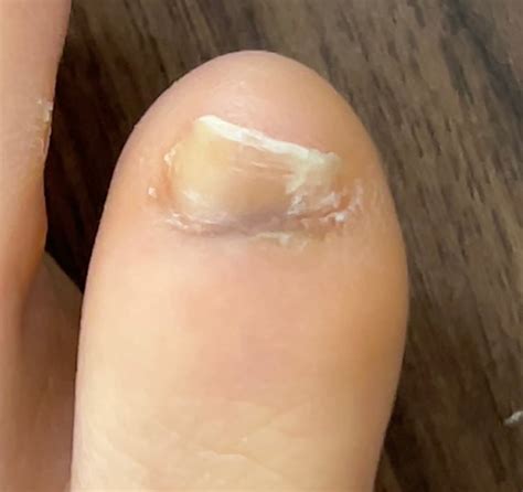 발톱에 검은색 점 같은게 있는데 뭔가요 지식in