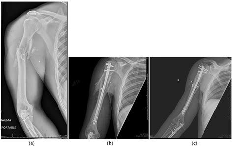 Proximal Humerus Fracture Classification