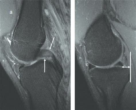 A The Pcl Has High Signal In The Proximal Part But The Peripheral