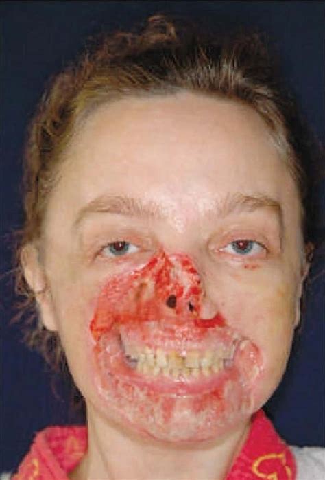 一、脸移植成功实例 中华器官移植