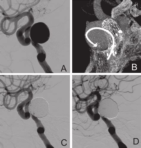 A 64 Year Old Woman Presented With Trigeminal Neuralgia A An Download Scientific Diagram