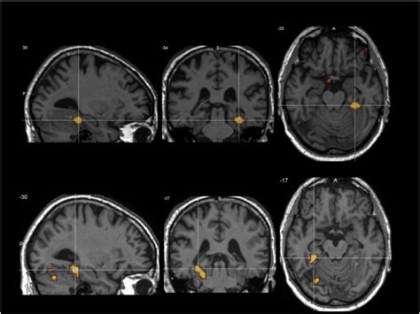 Top The Region Of The Right Parahippocampal Cortex Phc Located In Download Scientific