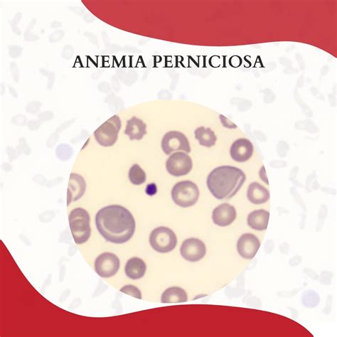 Anemia Perniciosa Atlas Em Hematologia