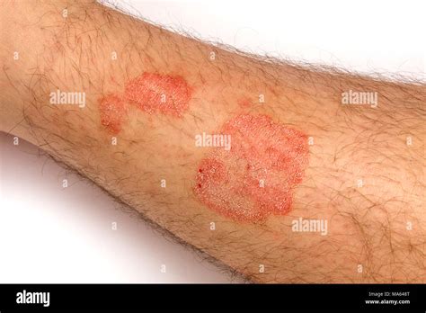Skin Diseases Psoriasis