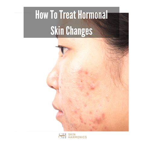 How To Treat Hormonal Skin Changes Skin Harmonics