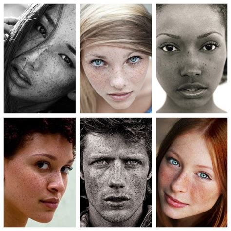 Complete Guide To Hyperpigmentation Types Causes And Treatments Complete Guide To Hyperpigmentation Types Causes And Treatments
