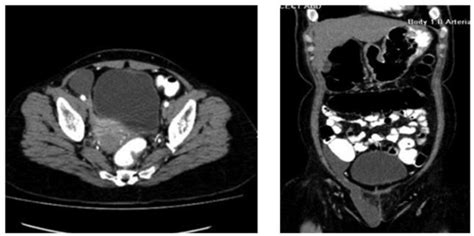 Ct Image Of Right Sided Hydrocele Of Canal Of Nuck Download Scientific Diagram