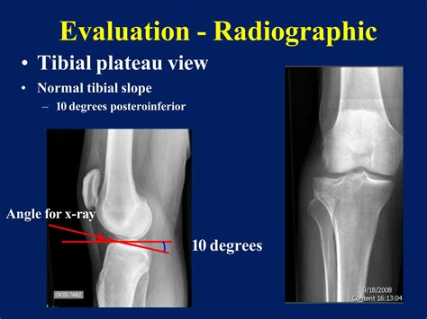Proximal Tibia Fractures And Its Management Pptx