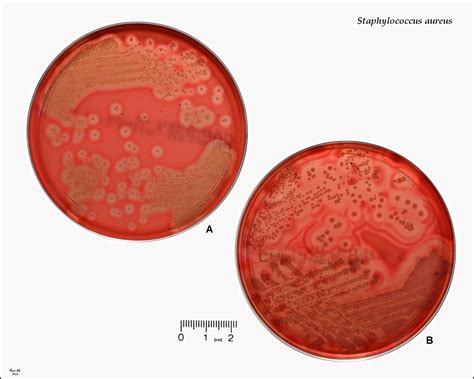 Streptococcus Salivarius Hemolysis