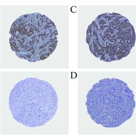 Photographs Of Tgf β And Pthrp Expression In Breast Cancer Tissues By