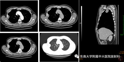 胸膜孤立性纤维瘤影像诊断 全网 检查 解剖图