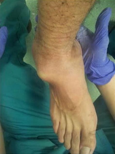 Subtalar Dislocation WikiSM Sports Medicine Wiki