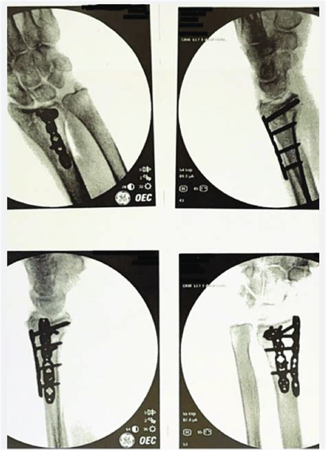 Bilateral Distal Radius Fracture Open Reduction And Internal Fixation