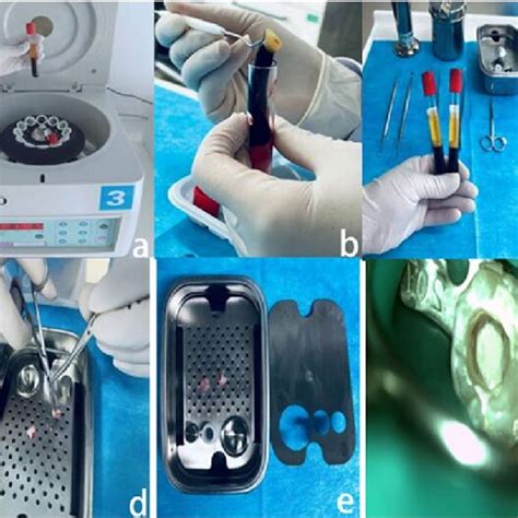 Prf Assisted Mature Permanent Teeth Revascularization Operation