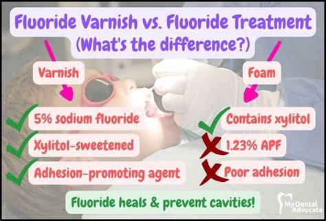 Fluoride Varnish Vs Fluoride Treatment Differences Mda