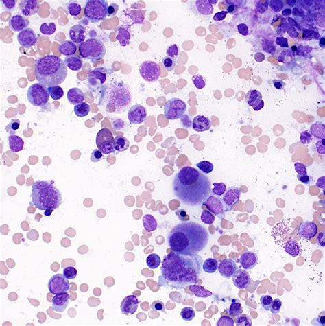 Pathology Outlines Myeloid Neoplasms With Germline Samd9 Mutation