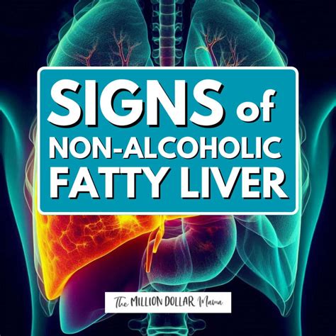 Signs That You May Have A Non Alcoholic Fatty Liver
