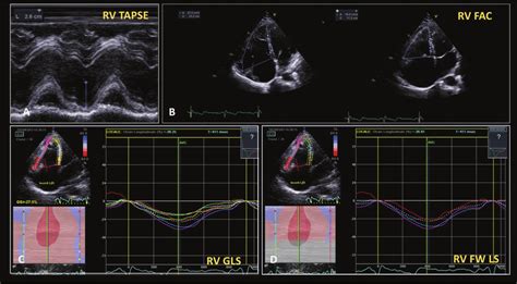 Right Ventricular Function Evaluation RV Function Evaluation Using Download Scientific Diagram