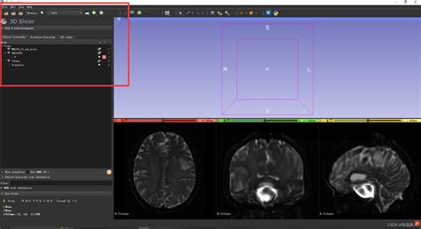 使用3d Slicer进行图像配准 Csdn博客