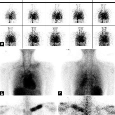 Tc 99m Methylene Diphosphonate Three Phase Skeletal Scintigraphy Download Scientific Diagram