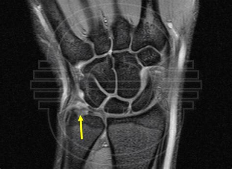 Cirugia De La Lesion Del Fibrocartilago Triangular Miembro Superior