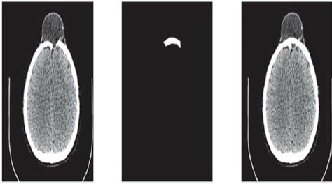 Missing Data In Dicom Format Of Slice 171 Download Scientific Diagram
